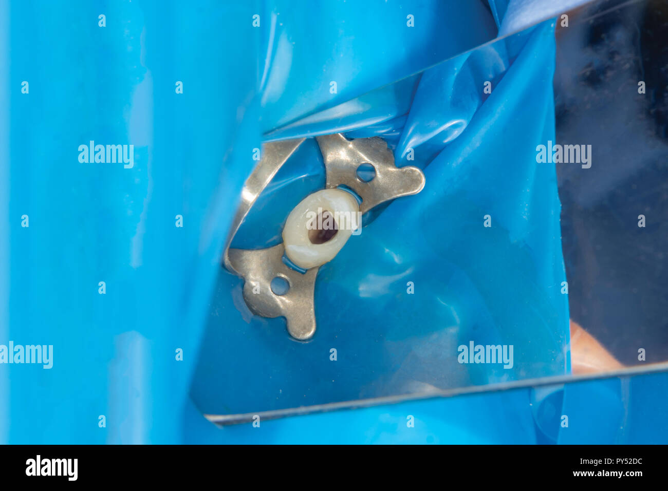 two chewing side teeth of the upper jaw after treatment of caries ...