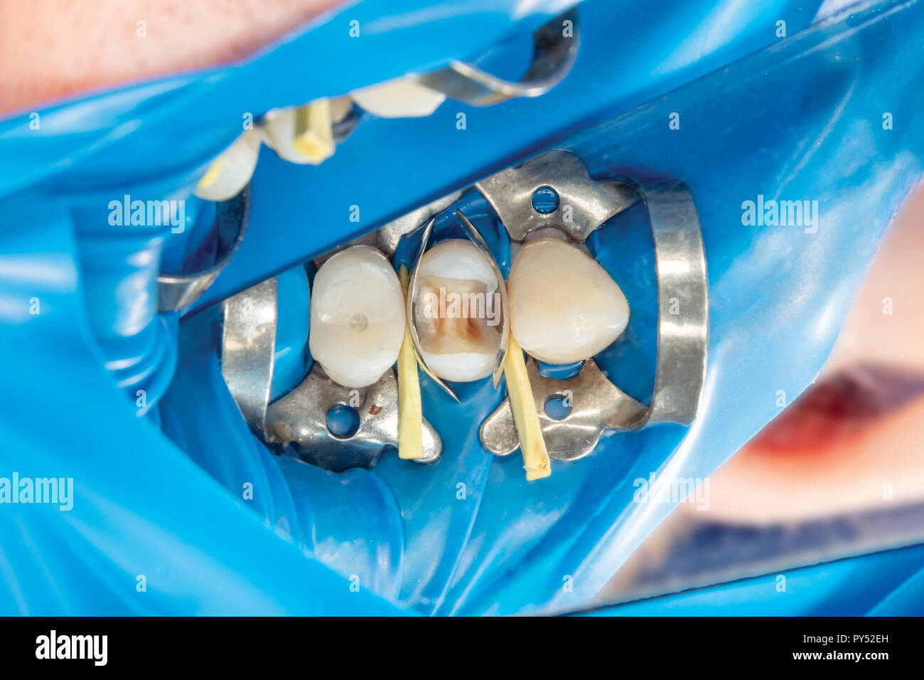 two chewing side teeth of the upper jaw after treatment of caries ...