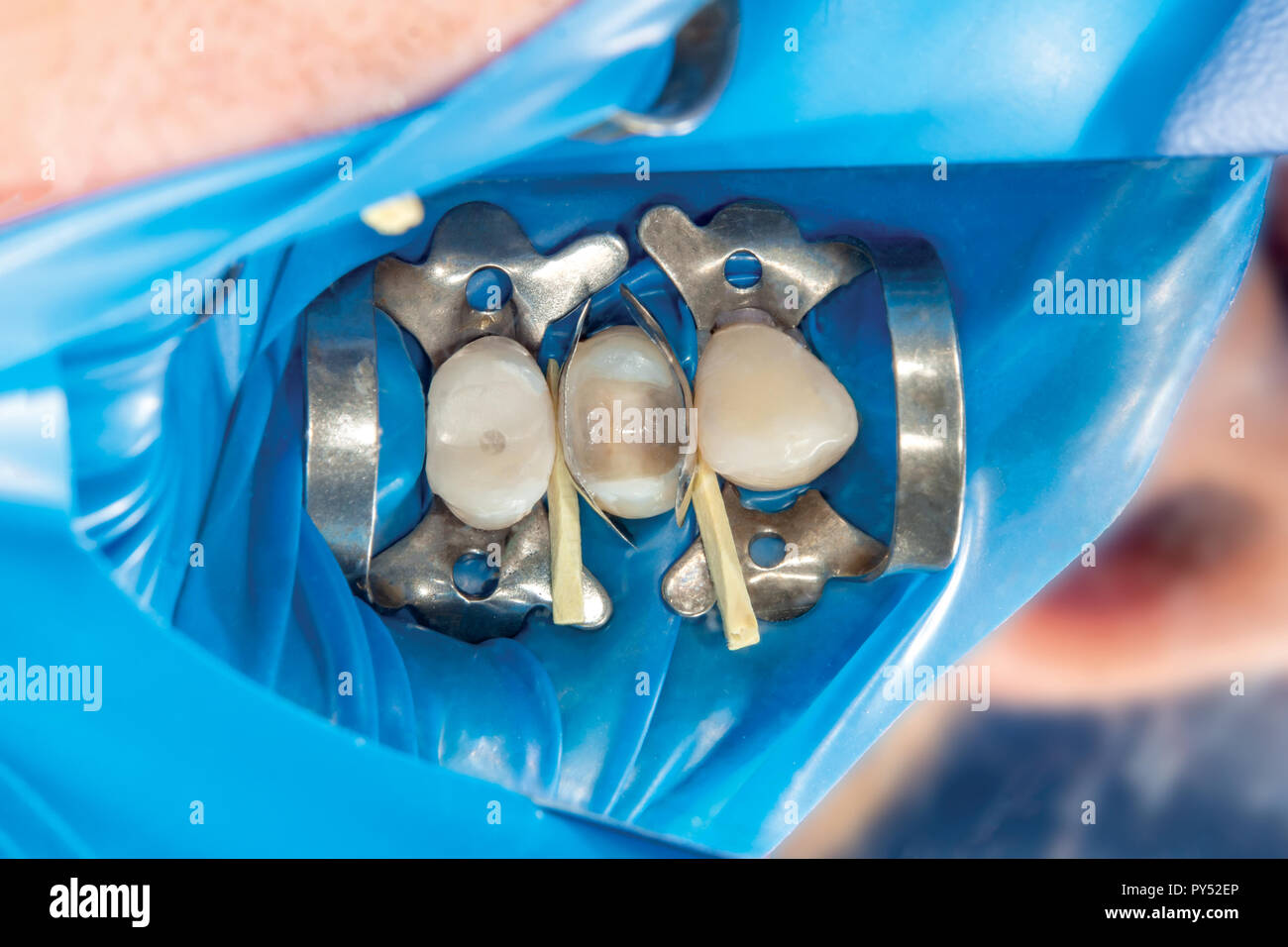 two chewing side teeth of the upper jaw after treatment of caries ...