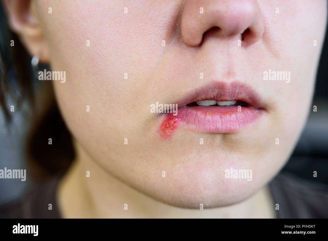 Herpes labialis hi-res stock photography and images - Alamy