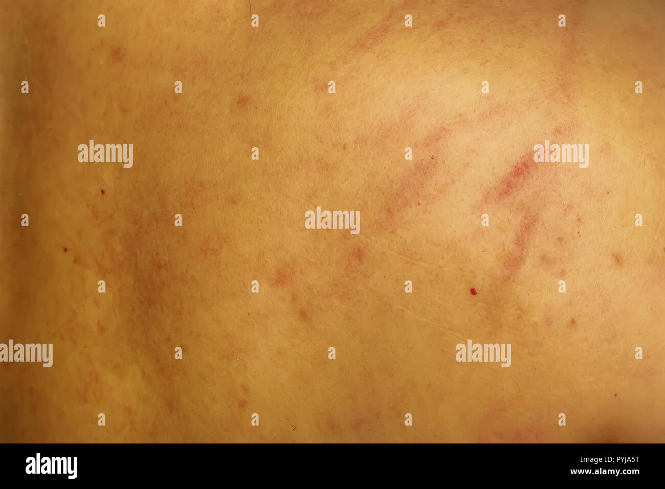 The wound at back was caused by scratches Stock Photo - Alamy