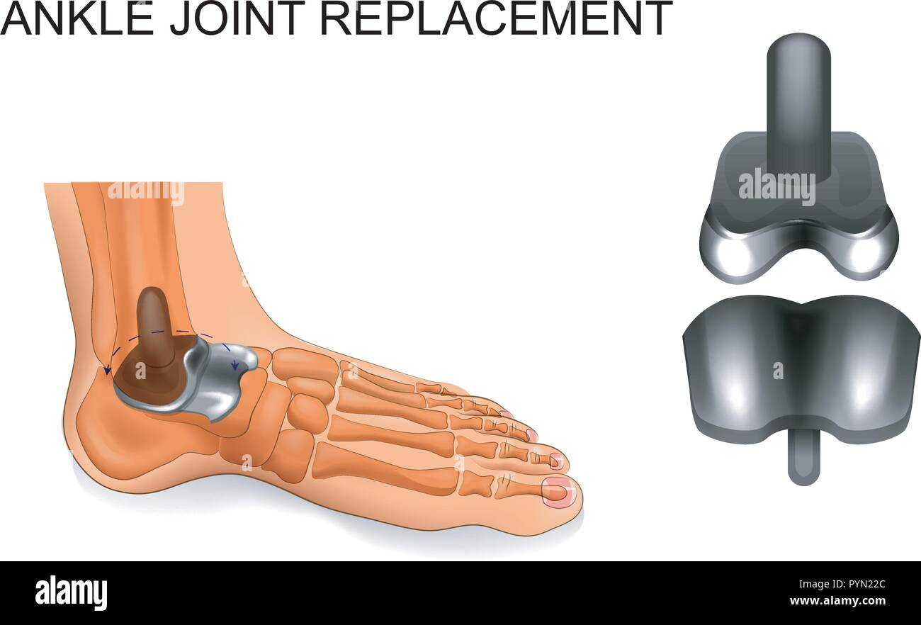 vector illustration of foot skeleton. ankle replacement Stock Vector ...