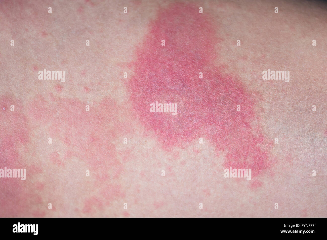 Close up of an itchy urticaria on woman leg Stock Photo - Alamy