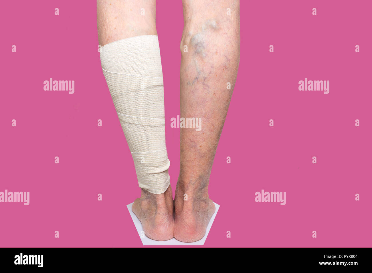 Tubular Bandage For Varicose Veins at Sherlyn Weyer blog