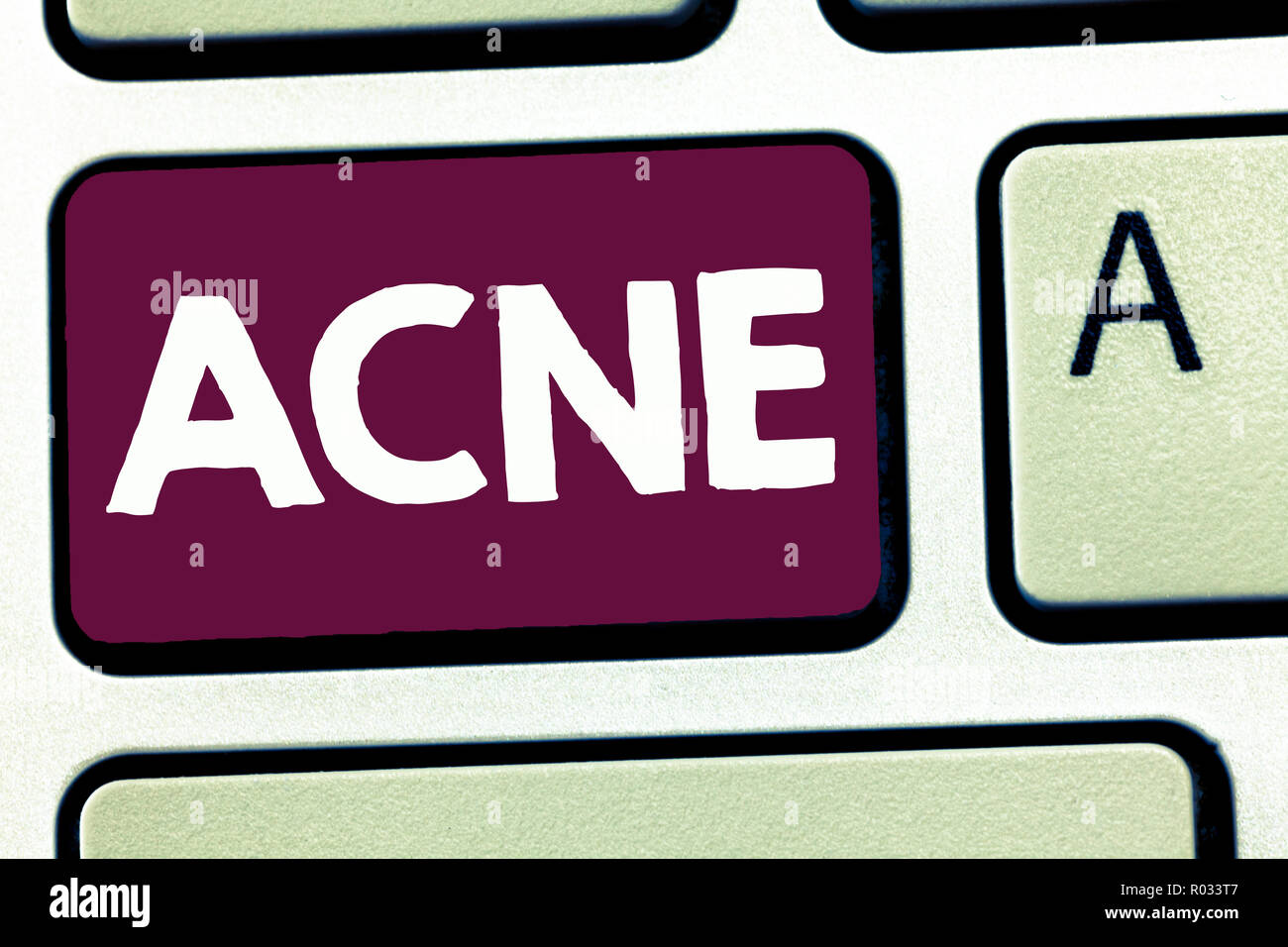 Text sign showing Acne. Conceptual photo Skin disease involving the oil ...