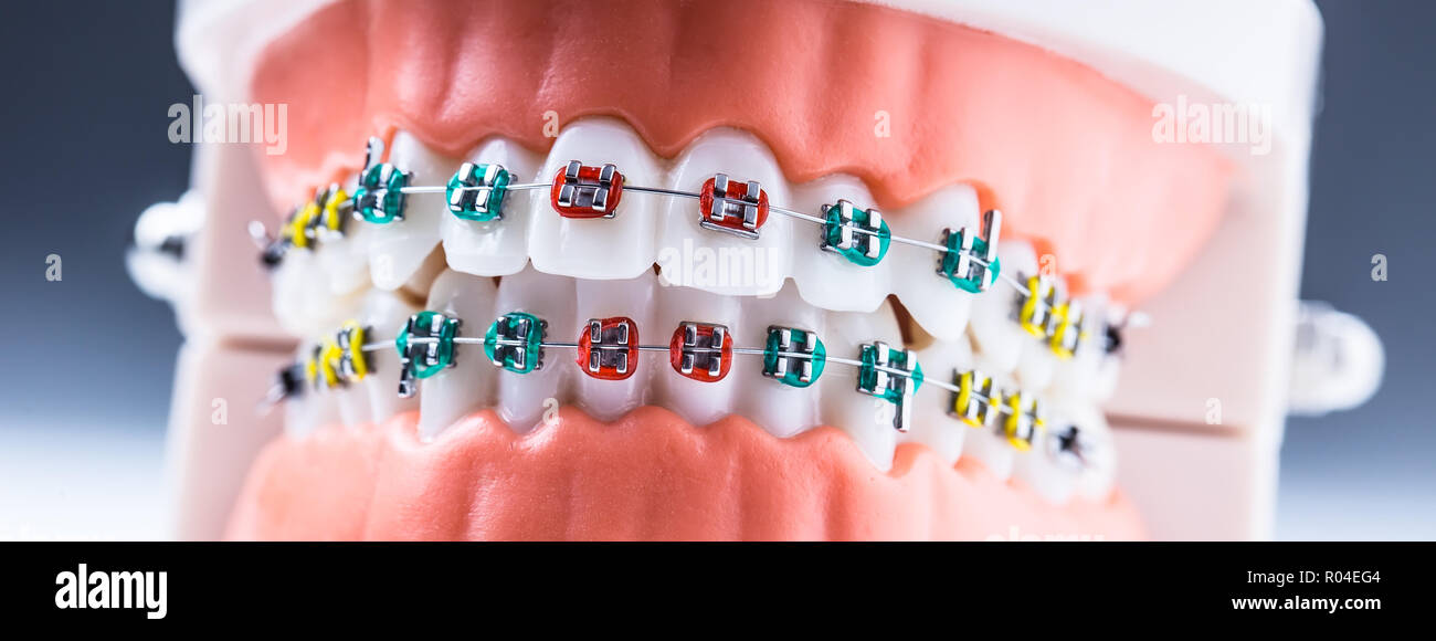 Close-up of a orthodontic model jaws and teeth with braces Stock Photo ...