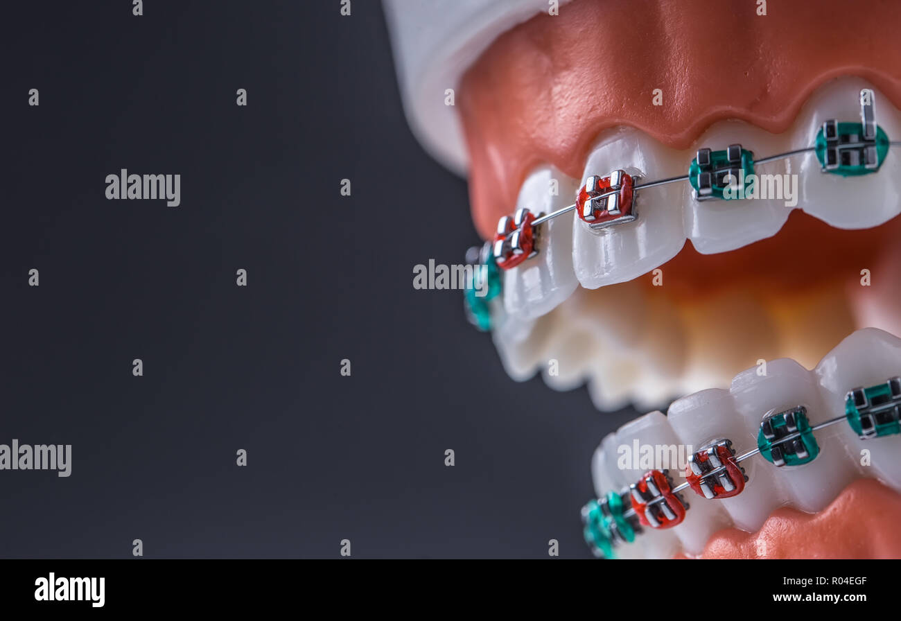 Orthodontic model hi-res stock photography and images - Alamy