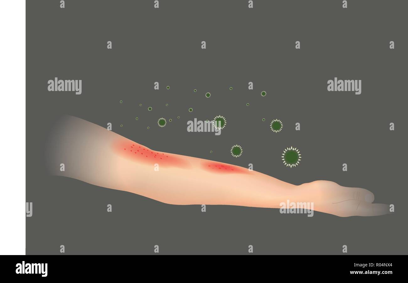 Shingles rash arm Stock Vector Images - Alamy