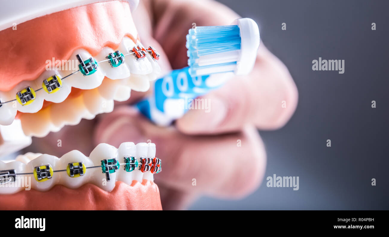 Close-up teeth braces and tooth brush as an example of toothbrushing ...