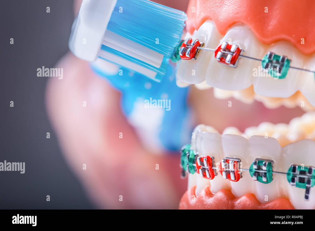 Close-up teeth braces and tooth brush as an example of toothbrushing ...