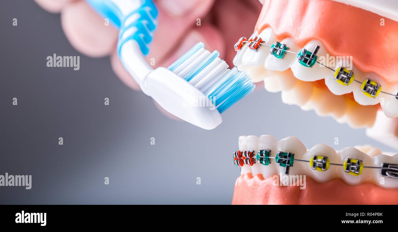Close-up teeth braces and tooth brush as an example of toothbrushing ...