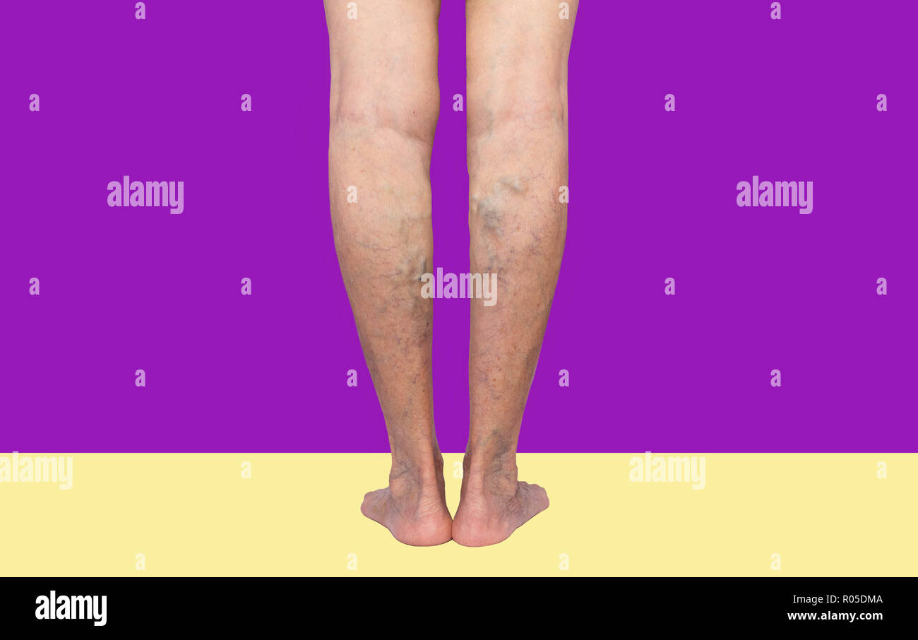 Varicose veins on a female legs Stock Photo - Alamy