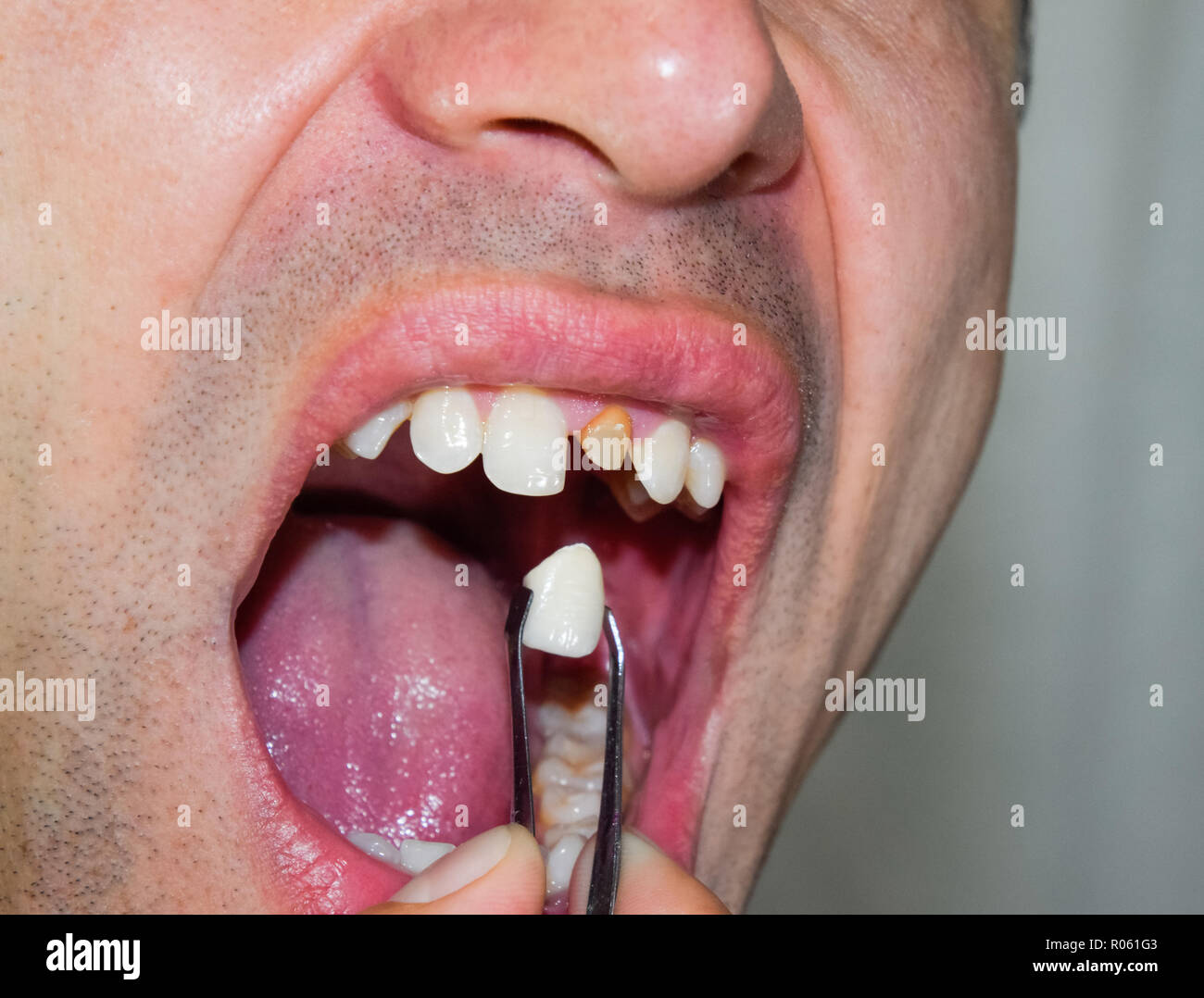 Dental prosthesis of metal ceramics in tweezers. A patient without a ...