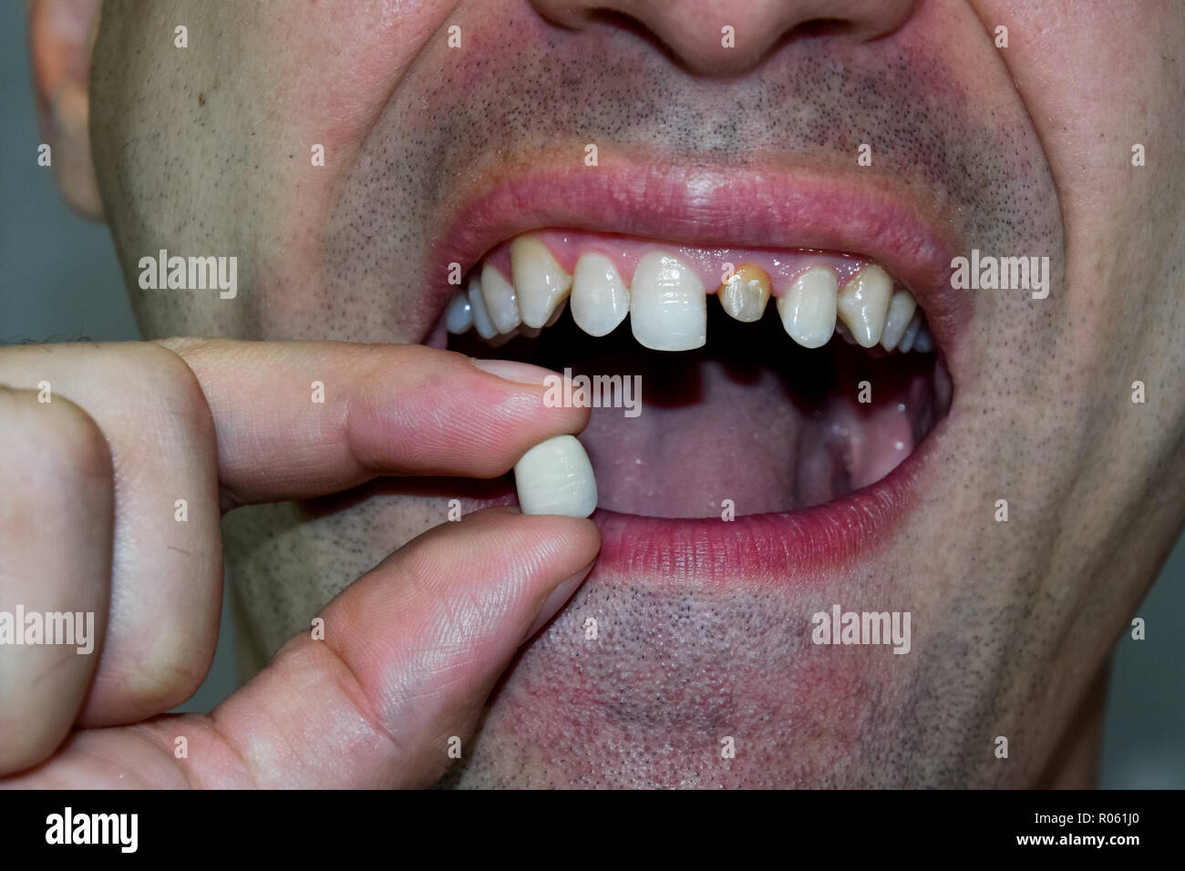 Dental prosthesis of metal ceramics in the hand of a man without a ...