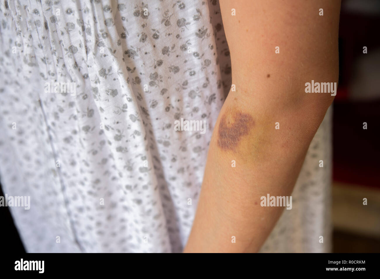 Bruised hands hi-res stock photography and images - Alamy