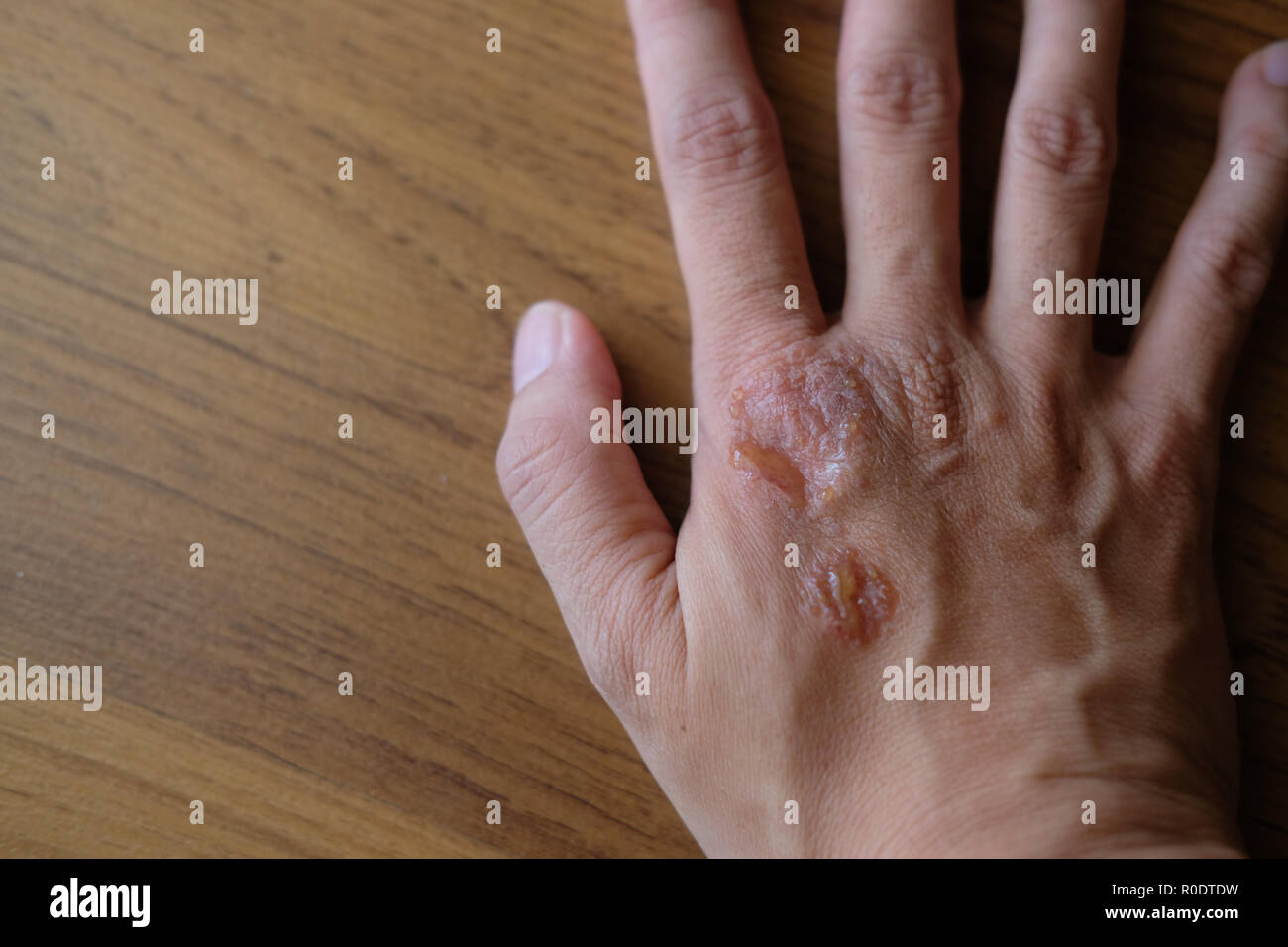Psoriasis Vulgaris Fungus Eczema On Female Hand With Pus Rash Dermatological Problem On Dry