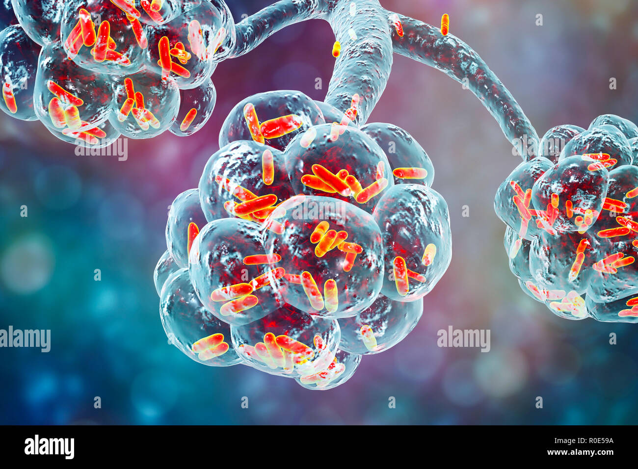 Bacterial pneumonia. Computer illustration of rod-shaped bacteria ...