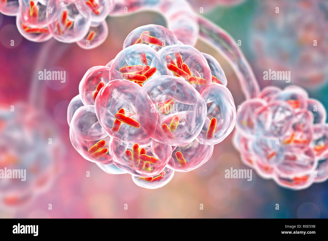 Bacterial pneumonia. Computer illustration of rod-shaped bacteria ...