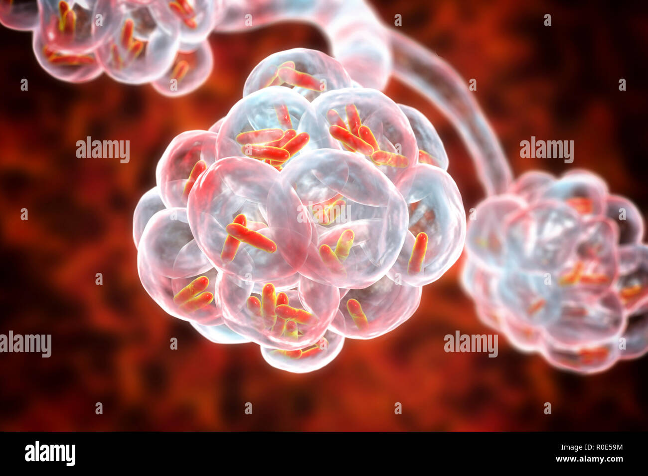 Bacterial pneumonia. Computer illustration of rod-shaped bacteria ...