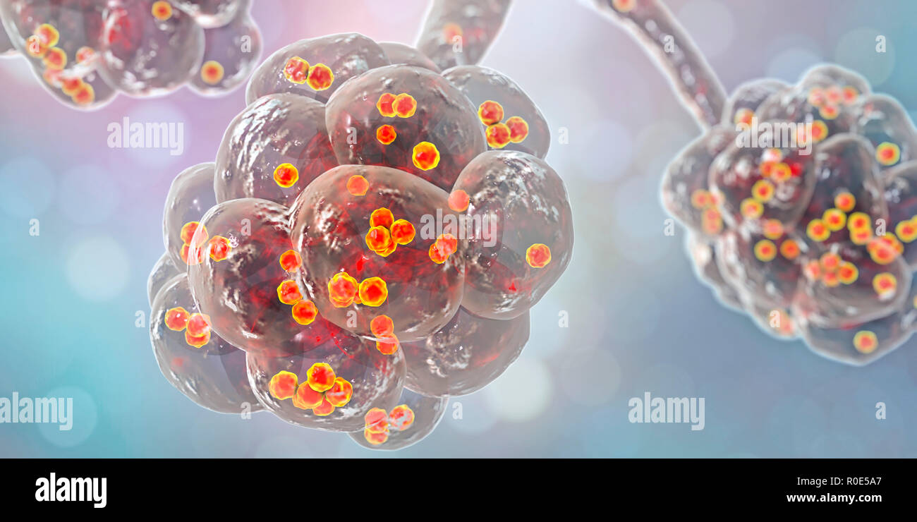 Staphylococcal pneumonia. Computer illustration of Staphylococcus ...