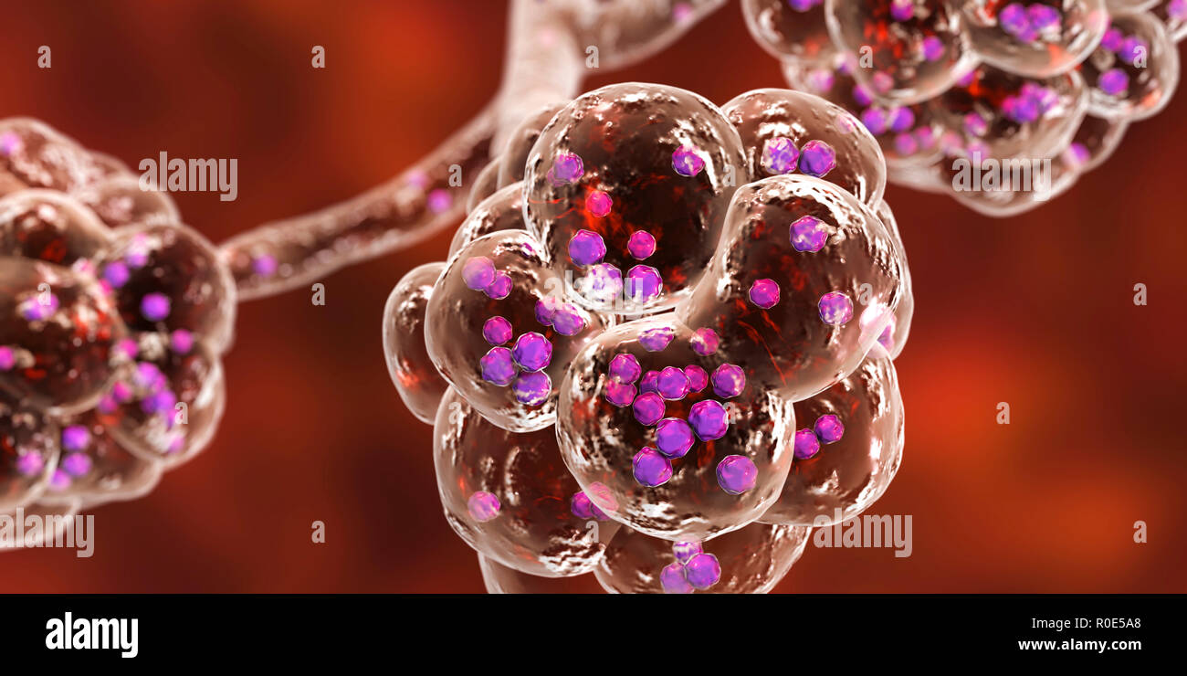 Staphylococcal pneumonia. Computer illustration of Staphylococcus ...
