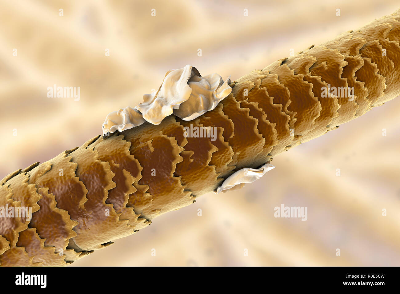 Pityriasis capitis hi-res stock photography and images - Alamy