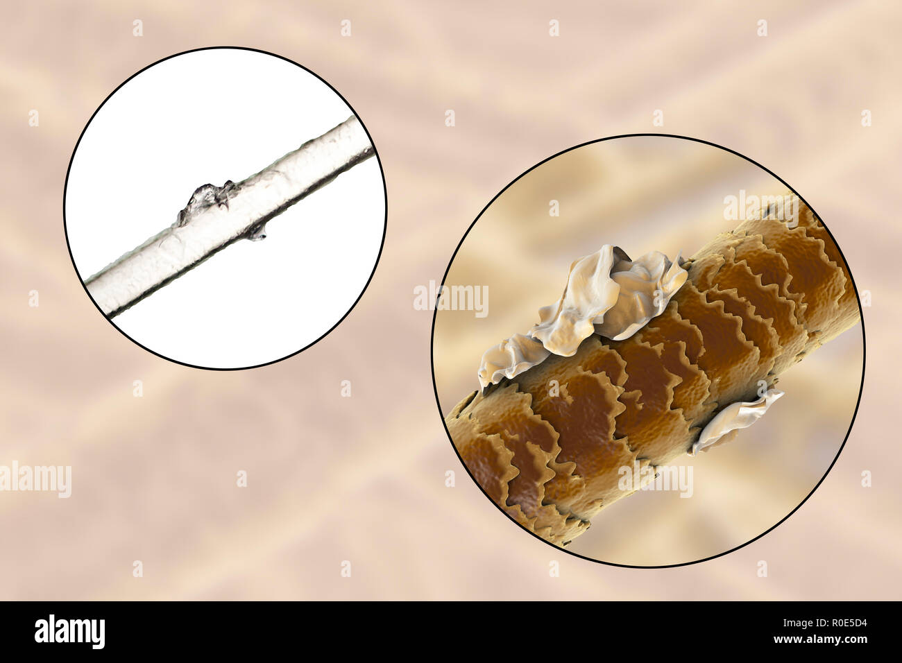 Pityriasis capitis hi-res stock photography and images - Alamy