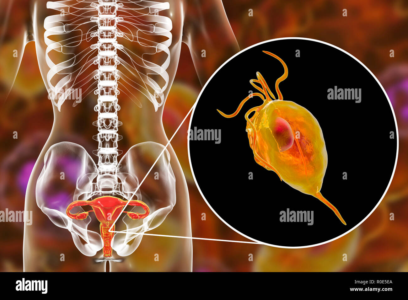 Trichomoniasis, illustration. Computer illustration of the female ...
