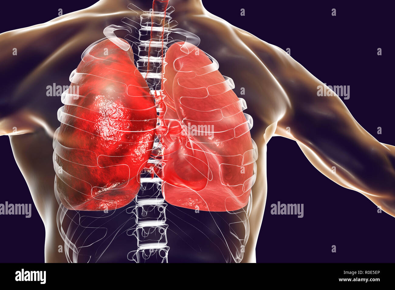 Pneumonia, illustration. Pneumonia is an inflammatory condition of the ...