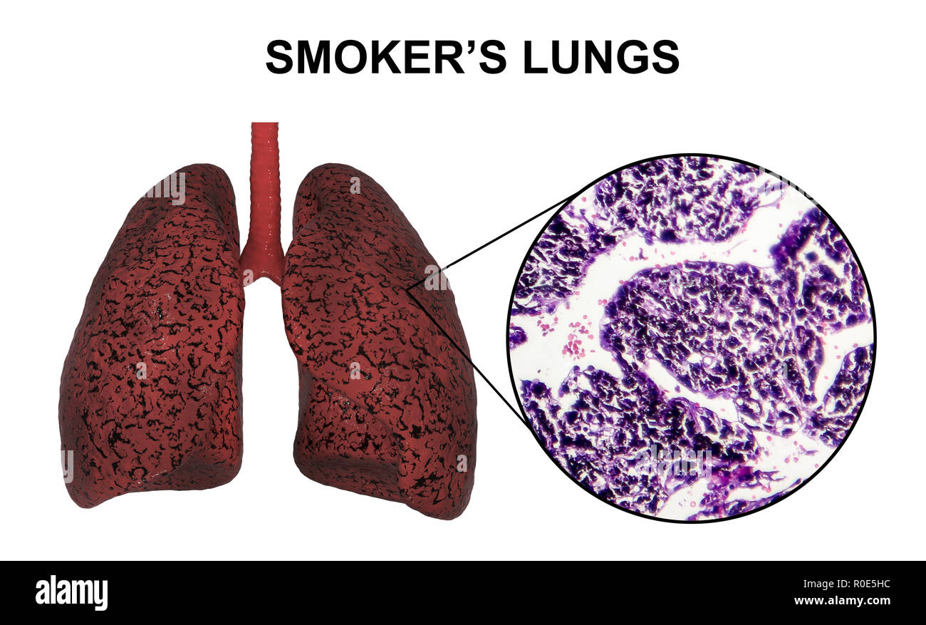 Lungs anatomy smoker hi-res stock photography and images - Alamy