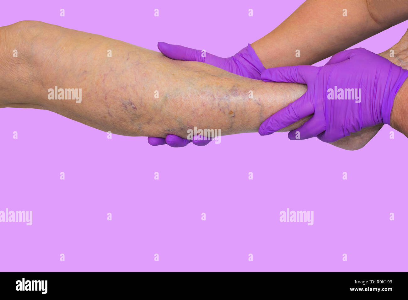 Lower limb vascular examination because suspect of venous insufficiency ...