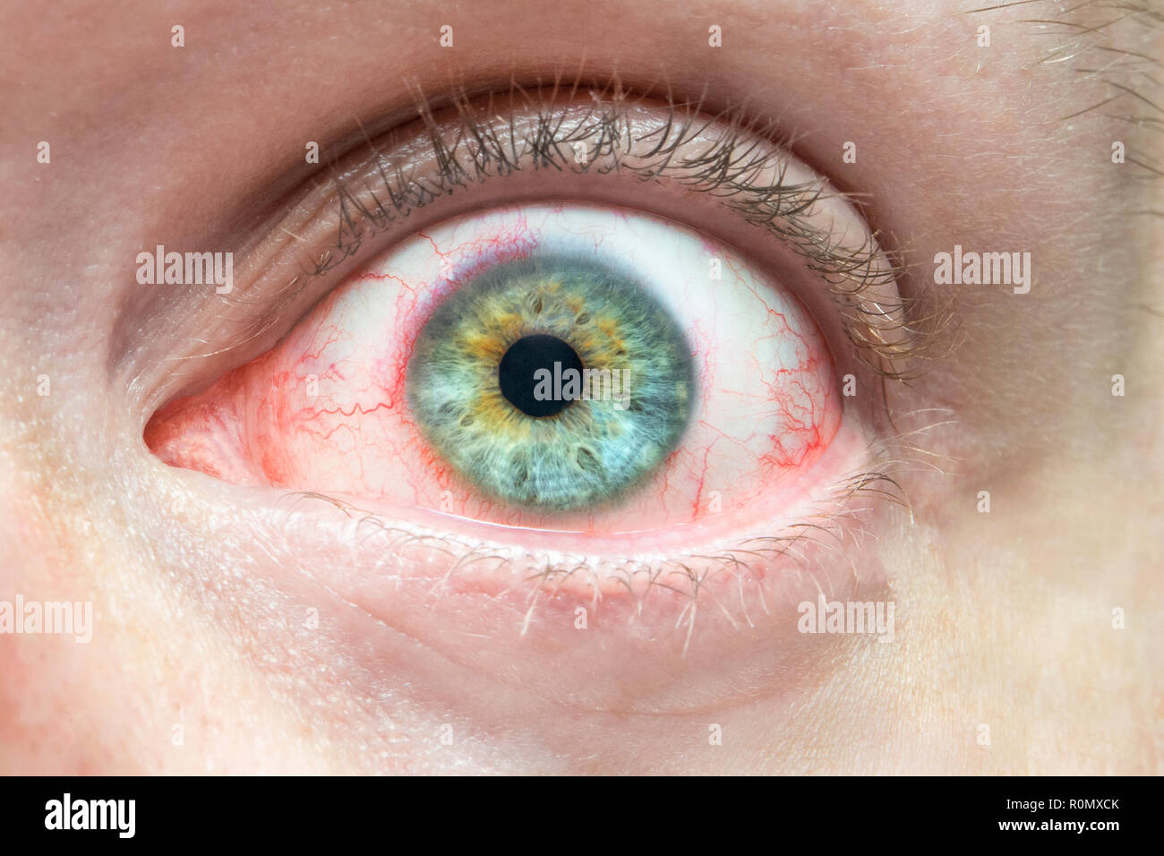 Mens irritated red eye close up, problems with blood vessels, fatigue ...