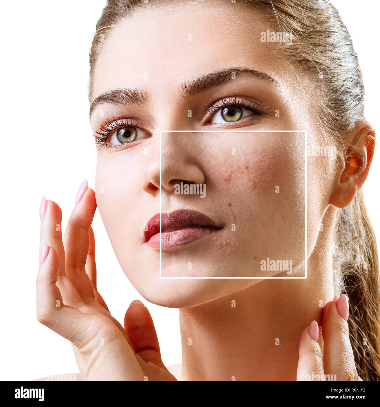 Young woman with acne skin in zoom square. Isolated on white Stock ...