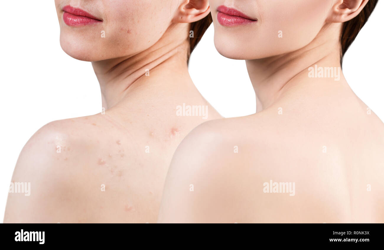Scabies human skin hi-res stock photography and images - Alamy