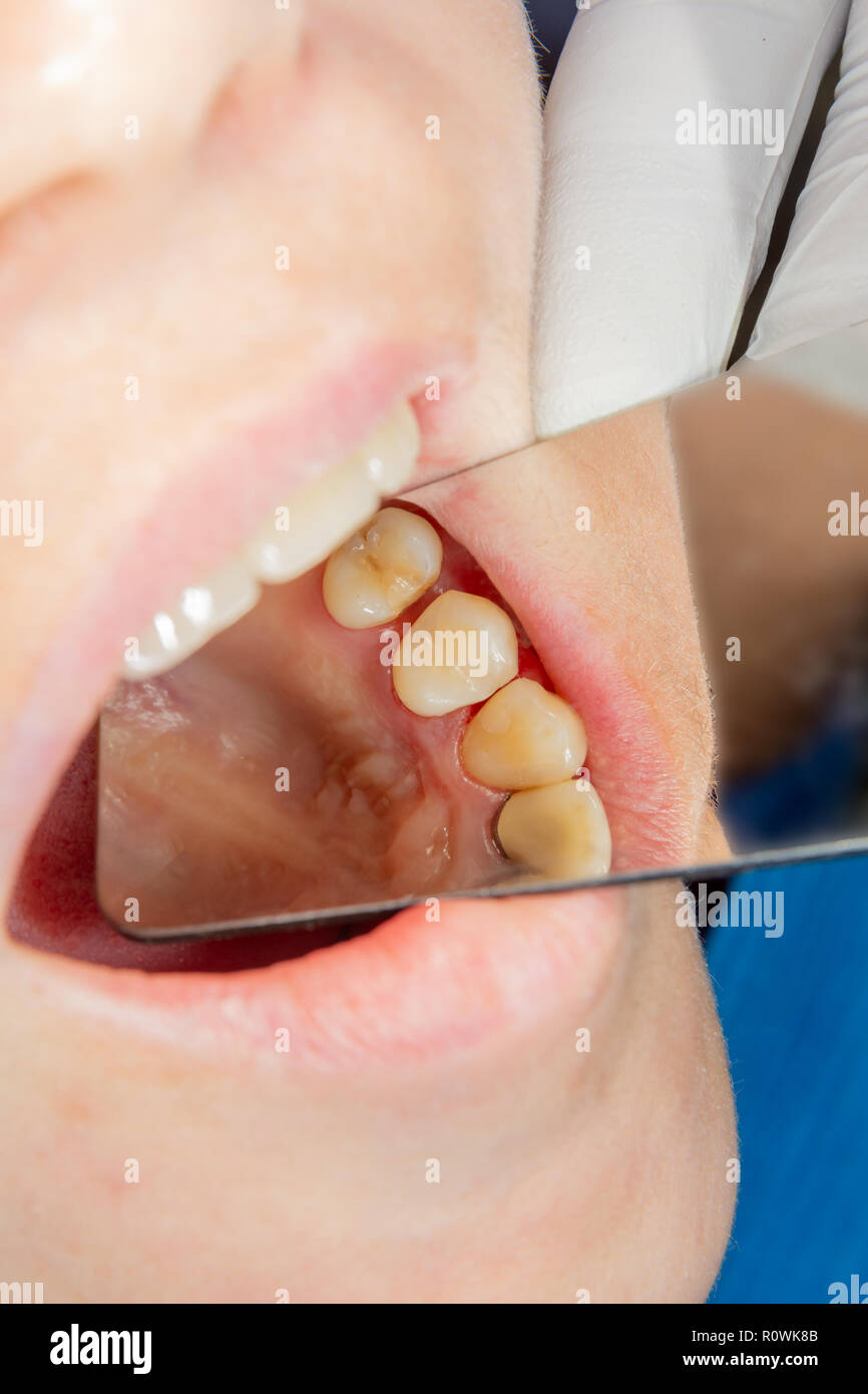 Rotten teeth child hi-res stock photography and images - Alamy