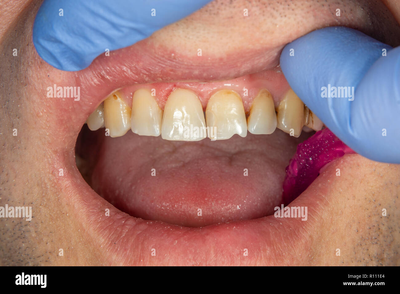 two chewing side teeth of the upper jaw after treatment of caries ...