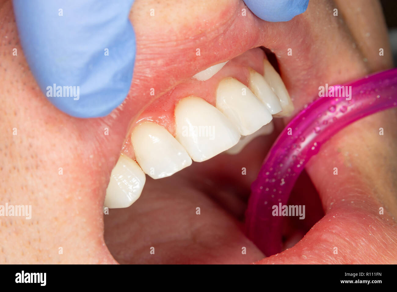 two chewing side teeth of the upper jaw after treatment of caries ...