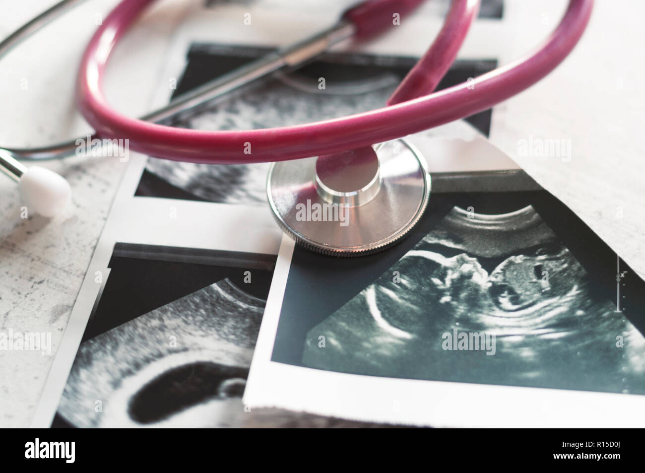 In the pictures of the ultrasound 4 weeks of pregnancy and 20 weeks is ...