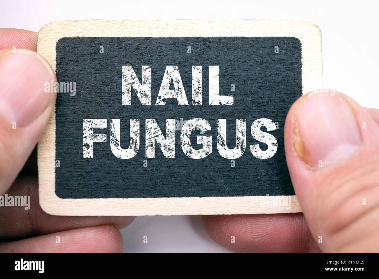 Nail fungus, text on blackboard Stock Photo - Alamy