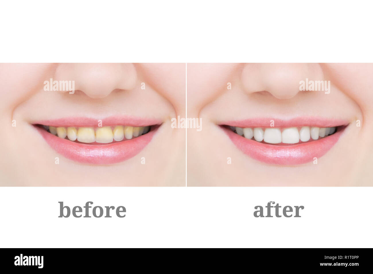 Teeth with yellow coating close-up after dental therapy and whitening ...