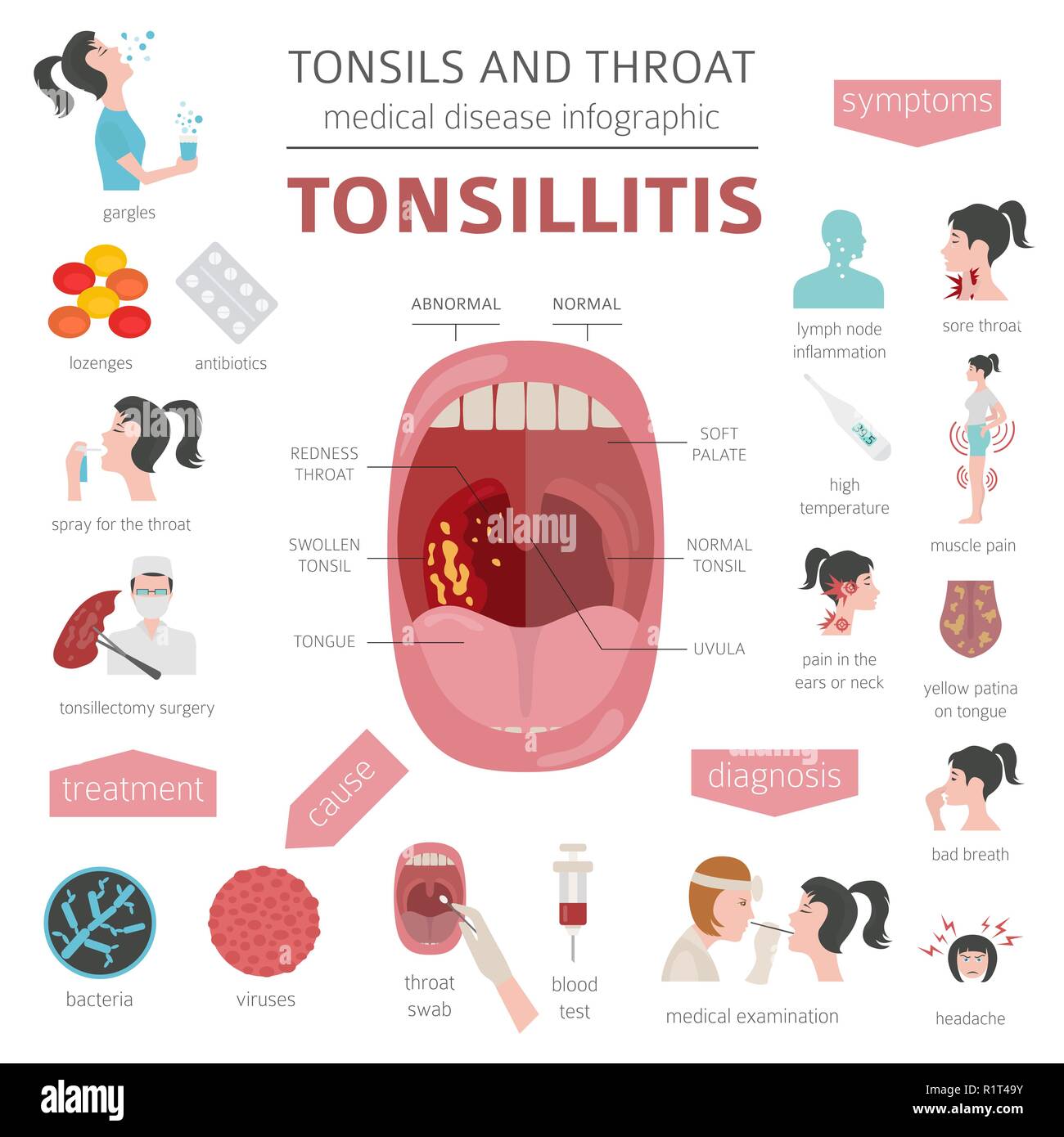 Tonsils and throat diseases. Tonsillitis symptoms, treatment icon set. Medical infographic ...