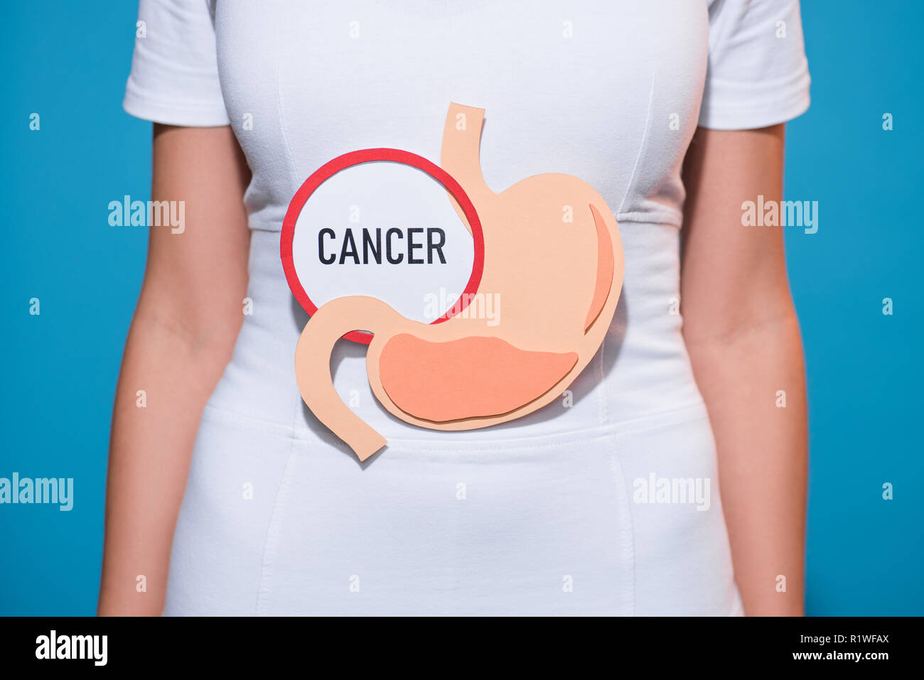 Stomach cancer hi-res stock photography and images - Alamy