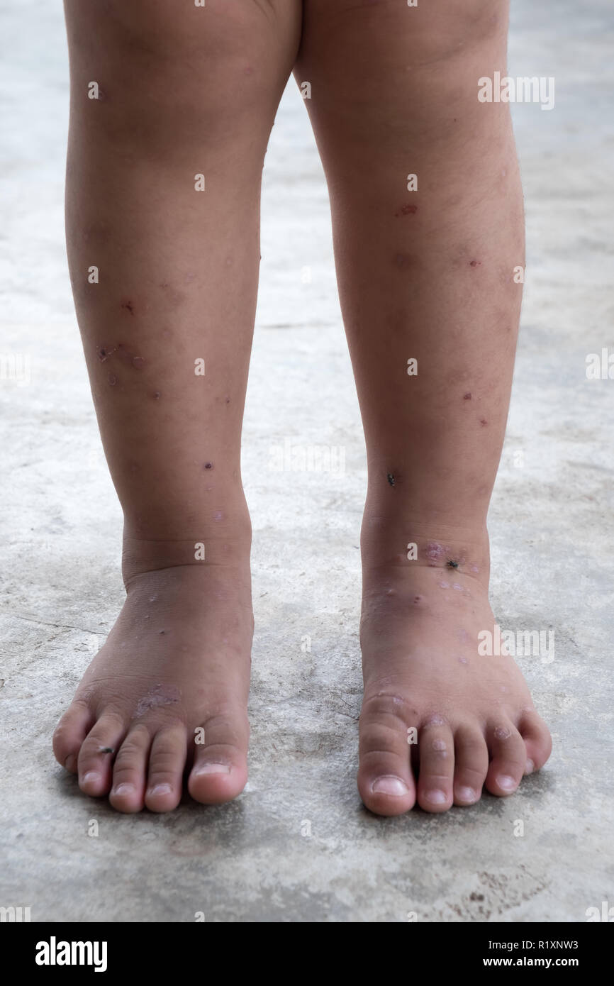 Itchy dermatitis atopic baby foot. Close up Infected wound.Opened wound ...