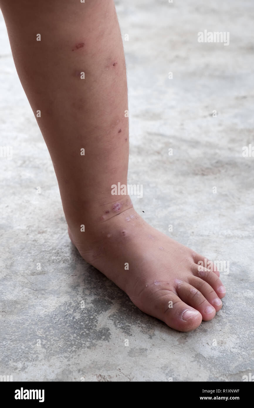 Infected Burn Stock Photos & Infected Burn Stock Images - Alamy