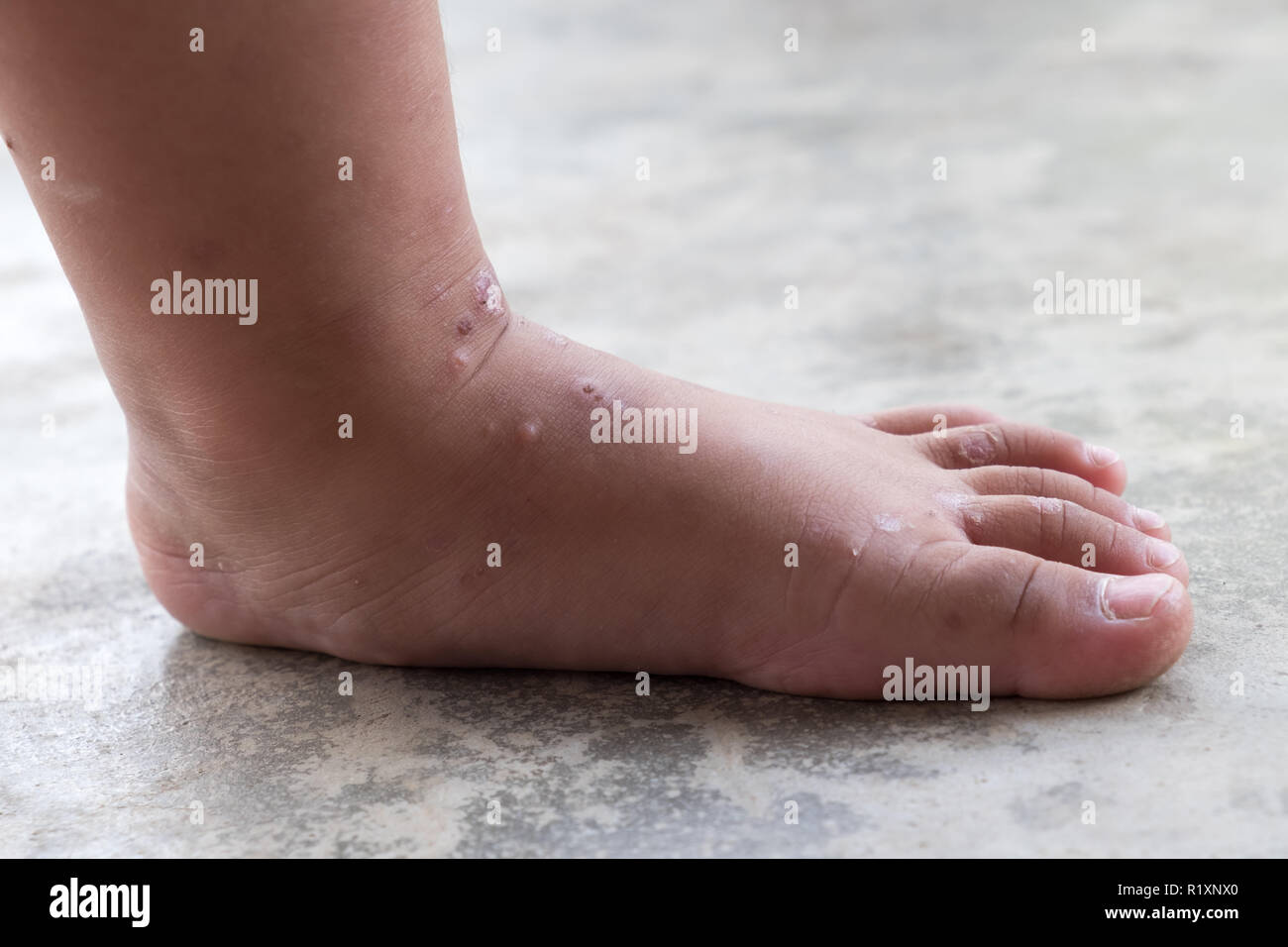Infected Burn Stock Photos & Infected Burn Stock Images - Alamy