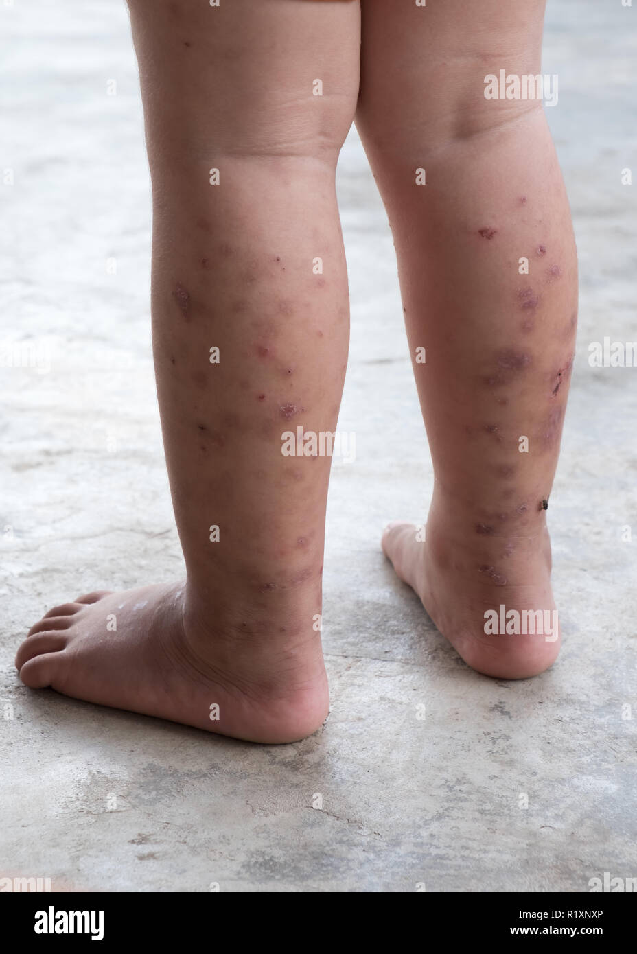 Itchy dermatitis atopic baby foot. Close up Infected wound.Opened wound ...