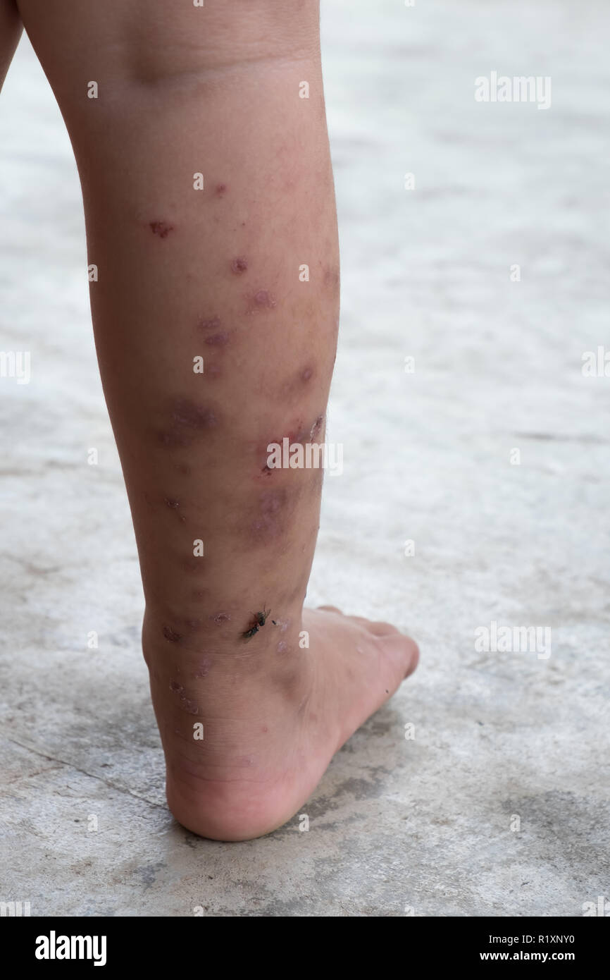 Infected Burn Stock Photos & Infected Burn Stock Images - Alamy