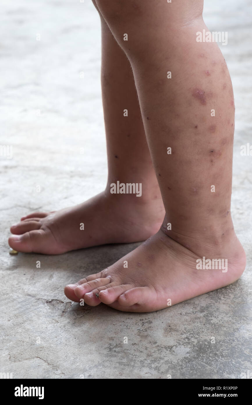 Scab And Itchy Stock Photos & Scab And Itchy Stock Images - Alamy