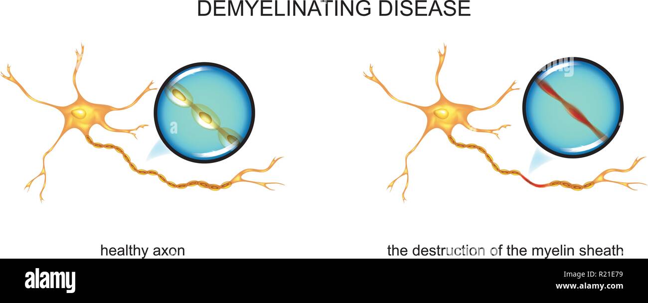 vector illustration of the process of nerve fiber destruction Stock ...