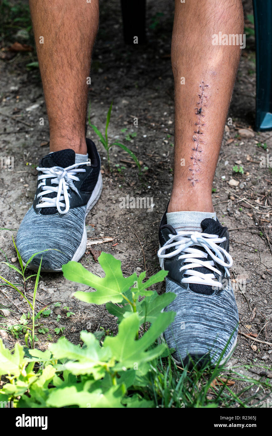 Closeup wound surgical stitch hi-res stock photography and images - Alamy